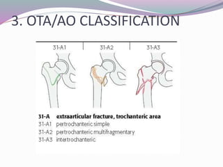 Intertrochanteric fracture femur | PPTX