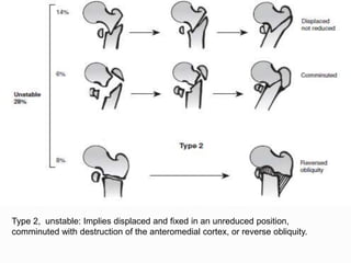 Evans Hip Fracture Classification