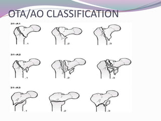 Evans Hip Fracture Classification