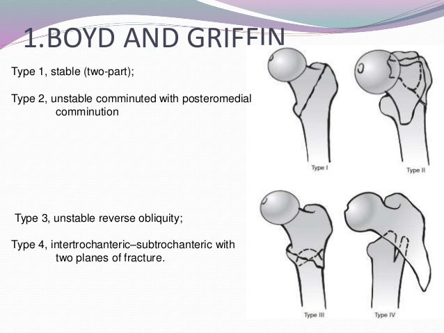 Intertrochanteric fracture femur