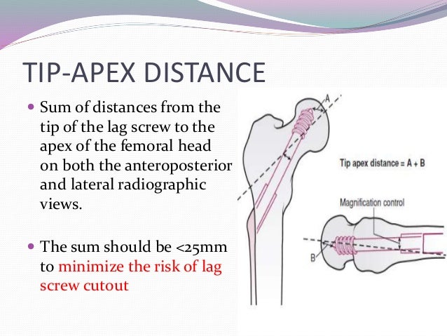Intertrochanteric fracture femur