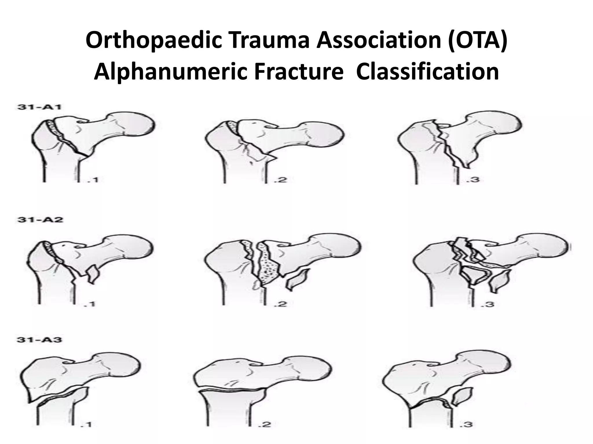 Intertrochanteric fractures / hip fracture | PPTX