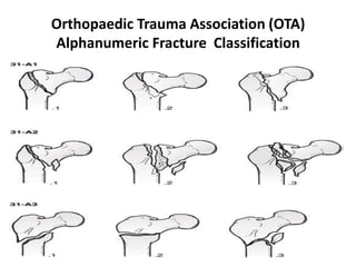 Evans Hip Fracture Classification