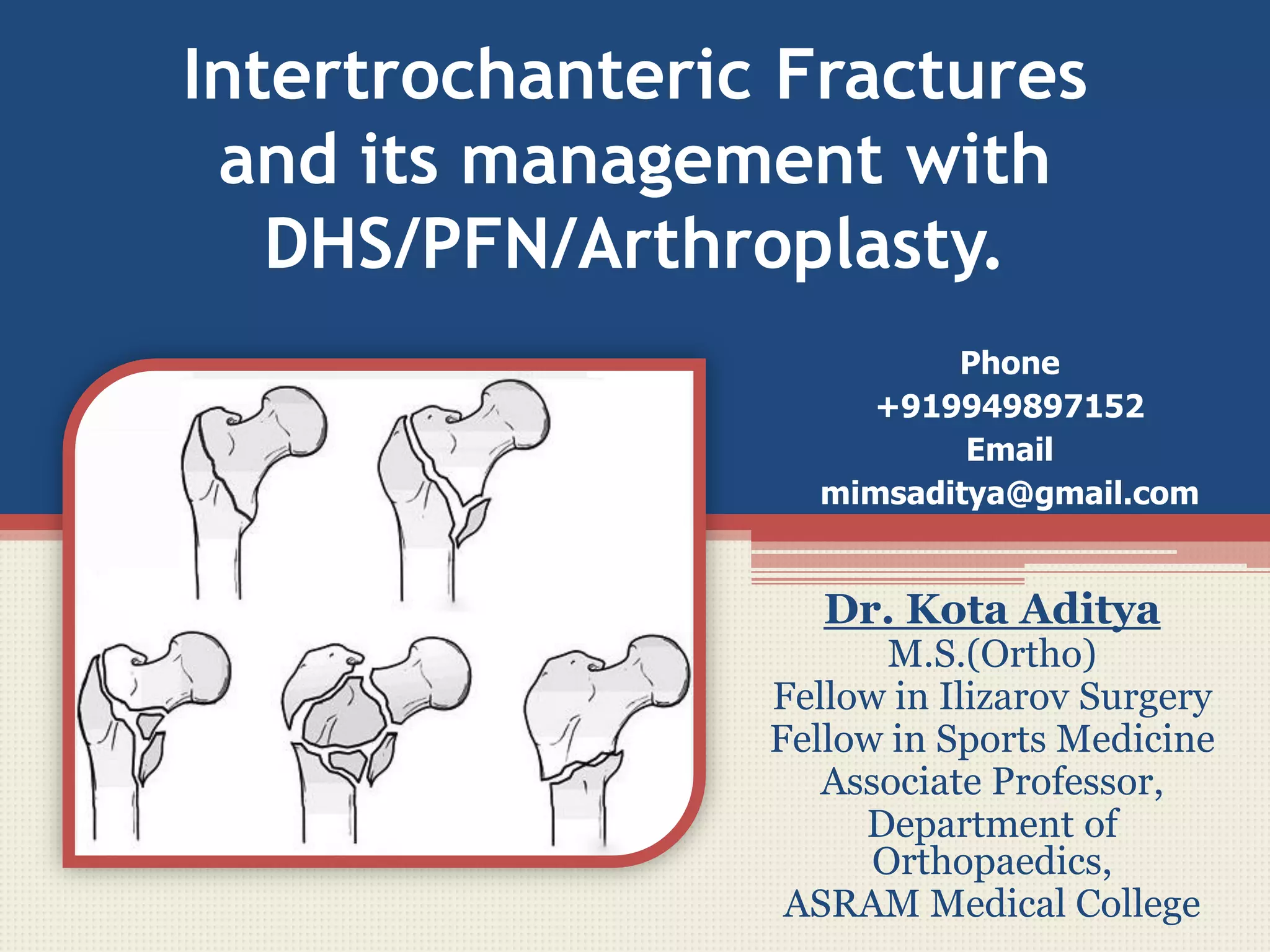 Intertrochanteric fractures and its management with DHS or PFN or ...