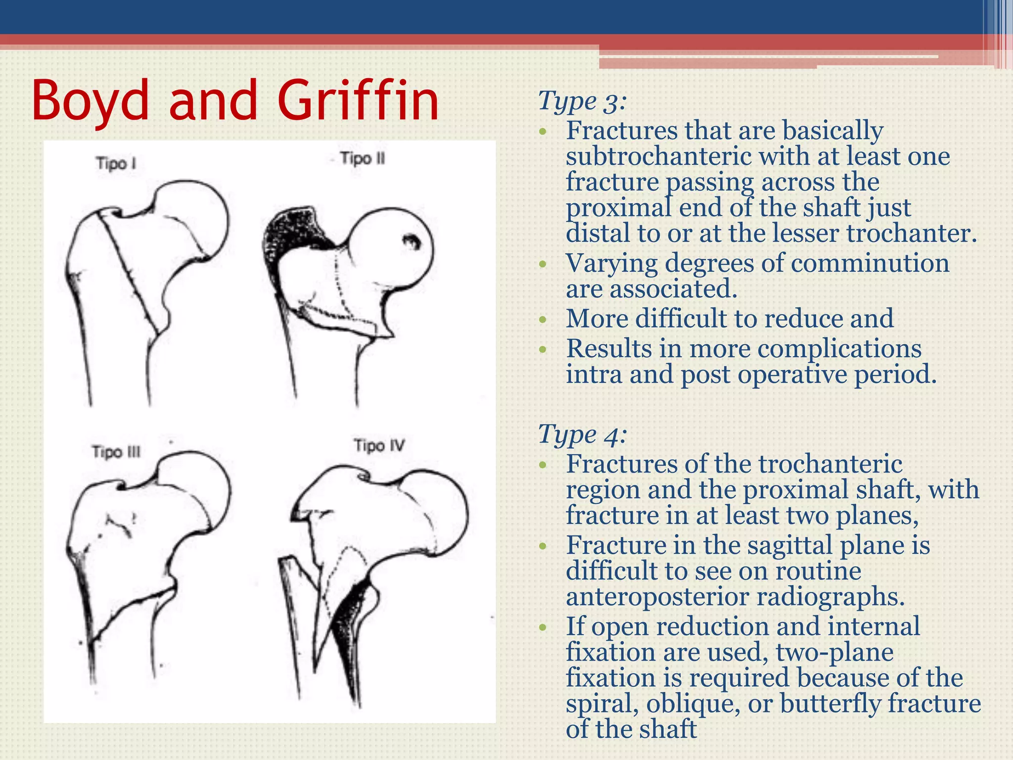 Intertrochanteric fractures and its management with DHS or PFN or ...