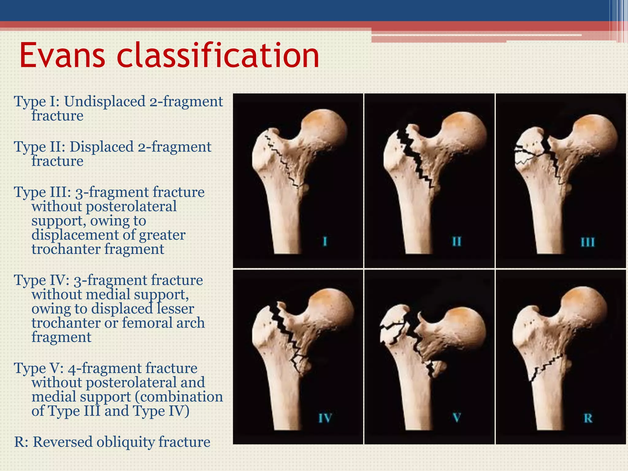 Intertrochanteric fractures and its management with DHS or PFN or ...