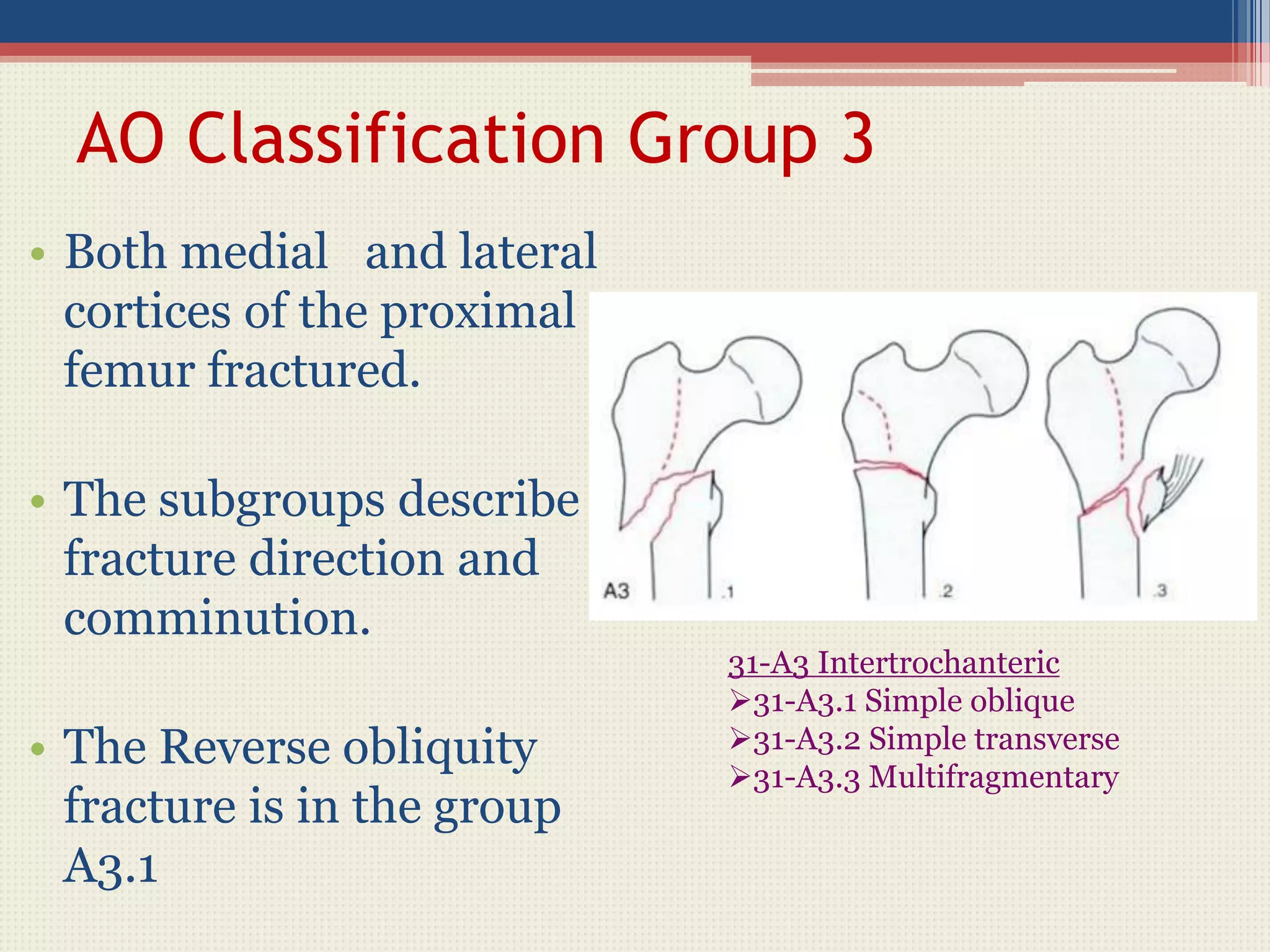 Intertrochanteric fractures and its management with DHS or PFN or ...