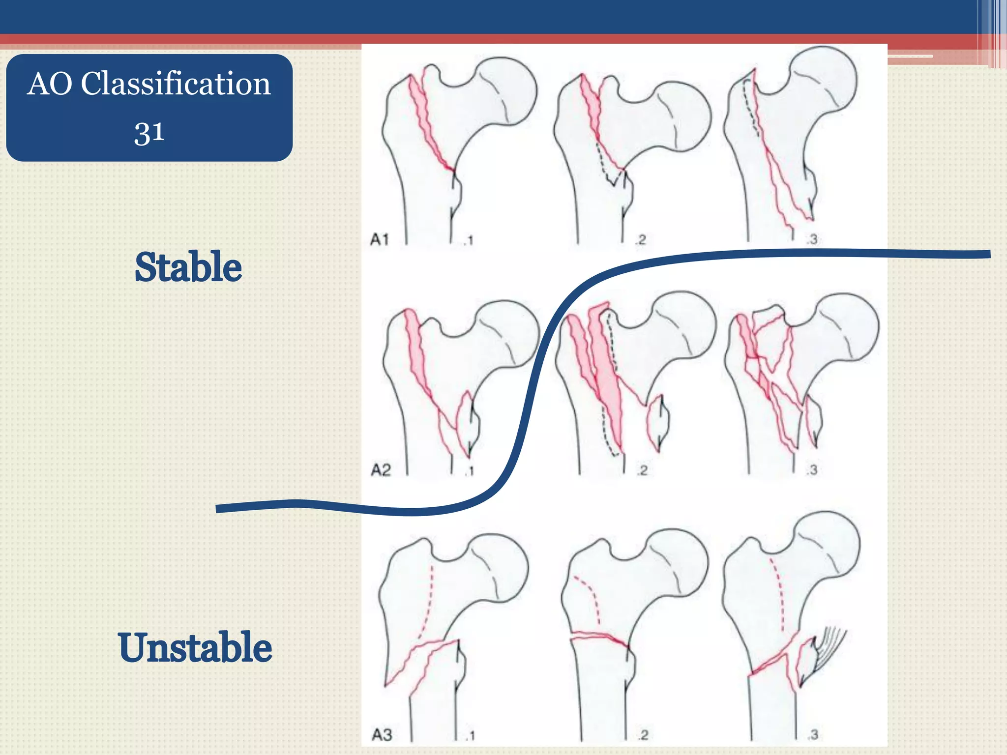 Intertrochanteric fractures and its management with DHS or PFN or ...