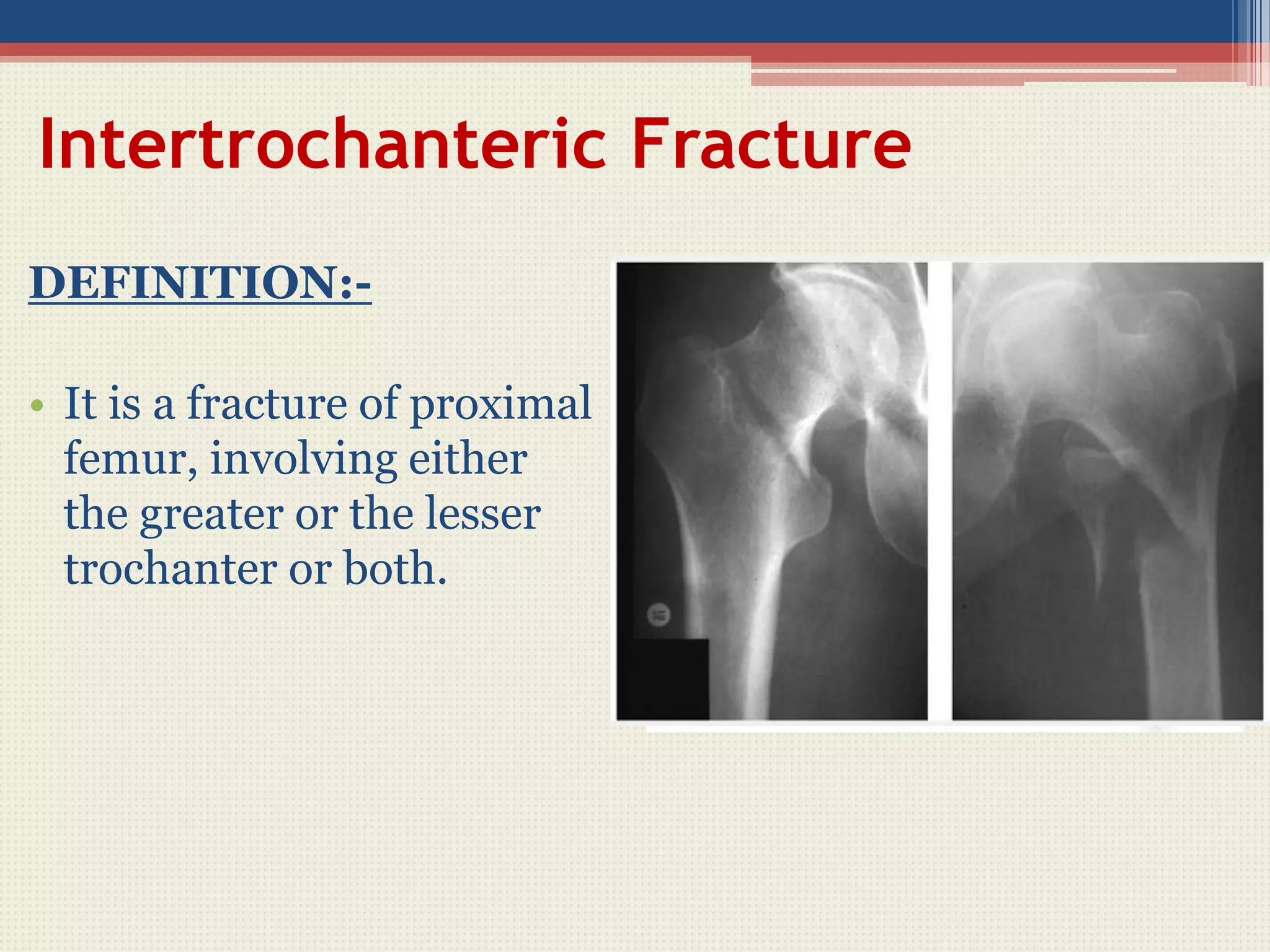 Intertrochanteric fractures and its management with DHS or PFN or ...