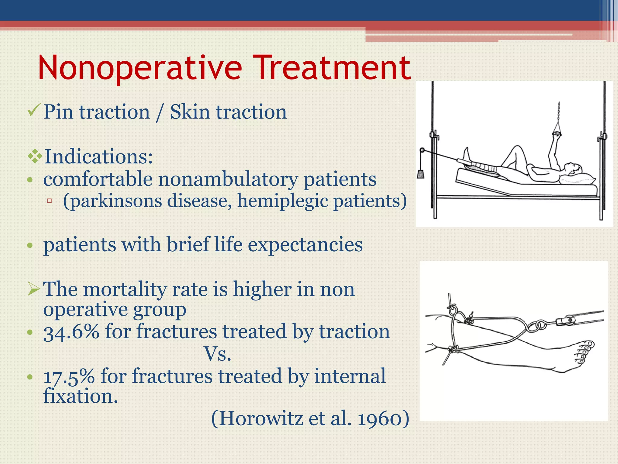 Intertrochanteric fractures and its management with DHS or PFN or ...