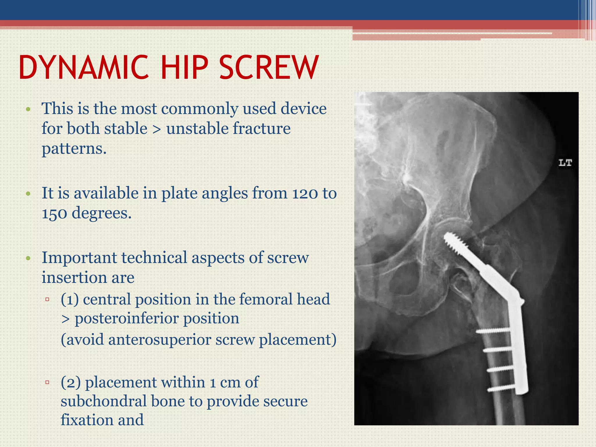 Intertrochanteric fractures and its management with DHS or PFN or ...
