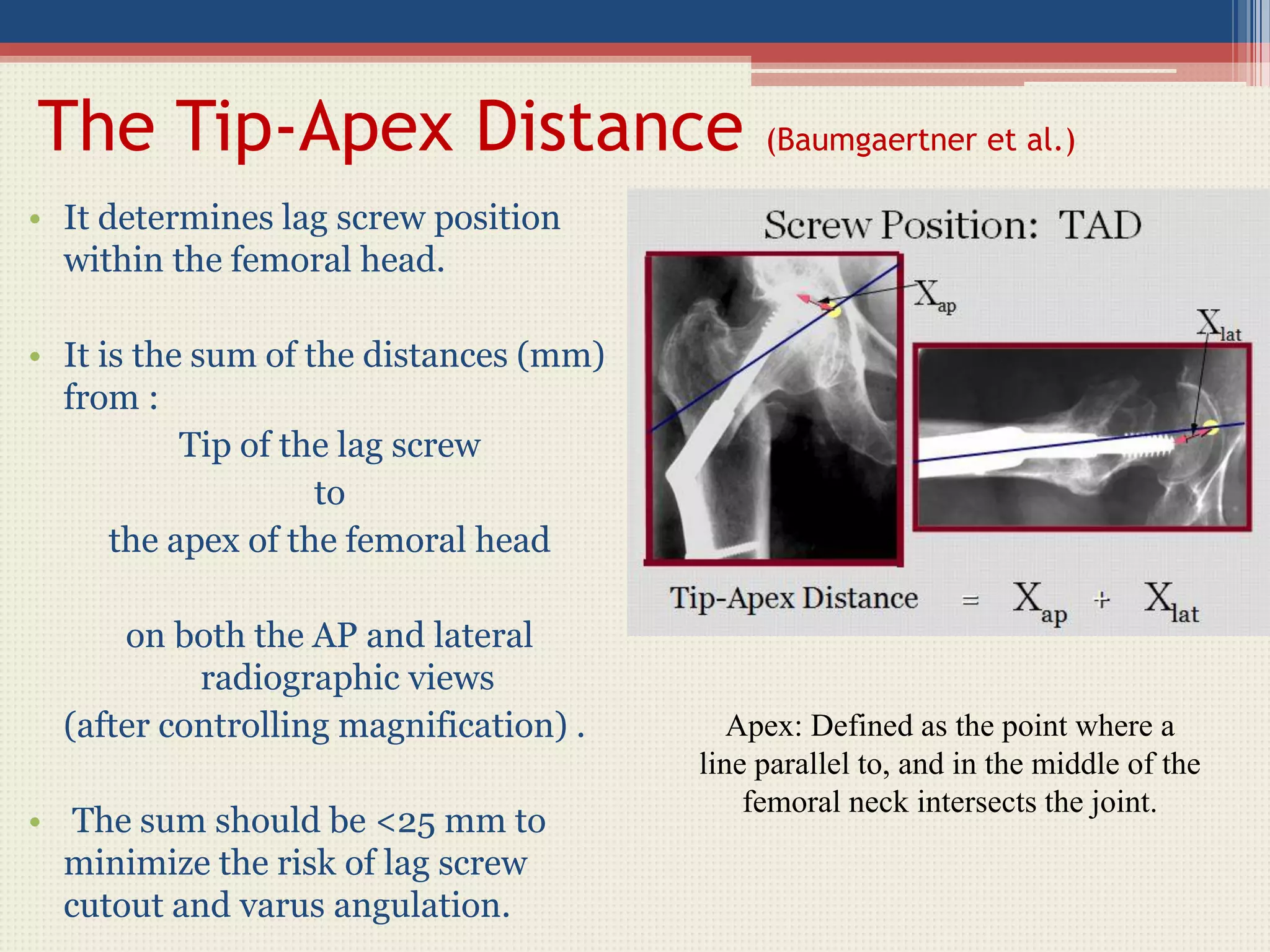 Intertrochanteric fractures and its management with DHS or PFN or ...