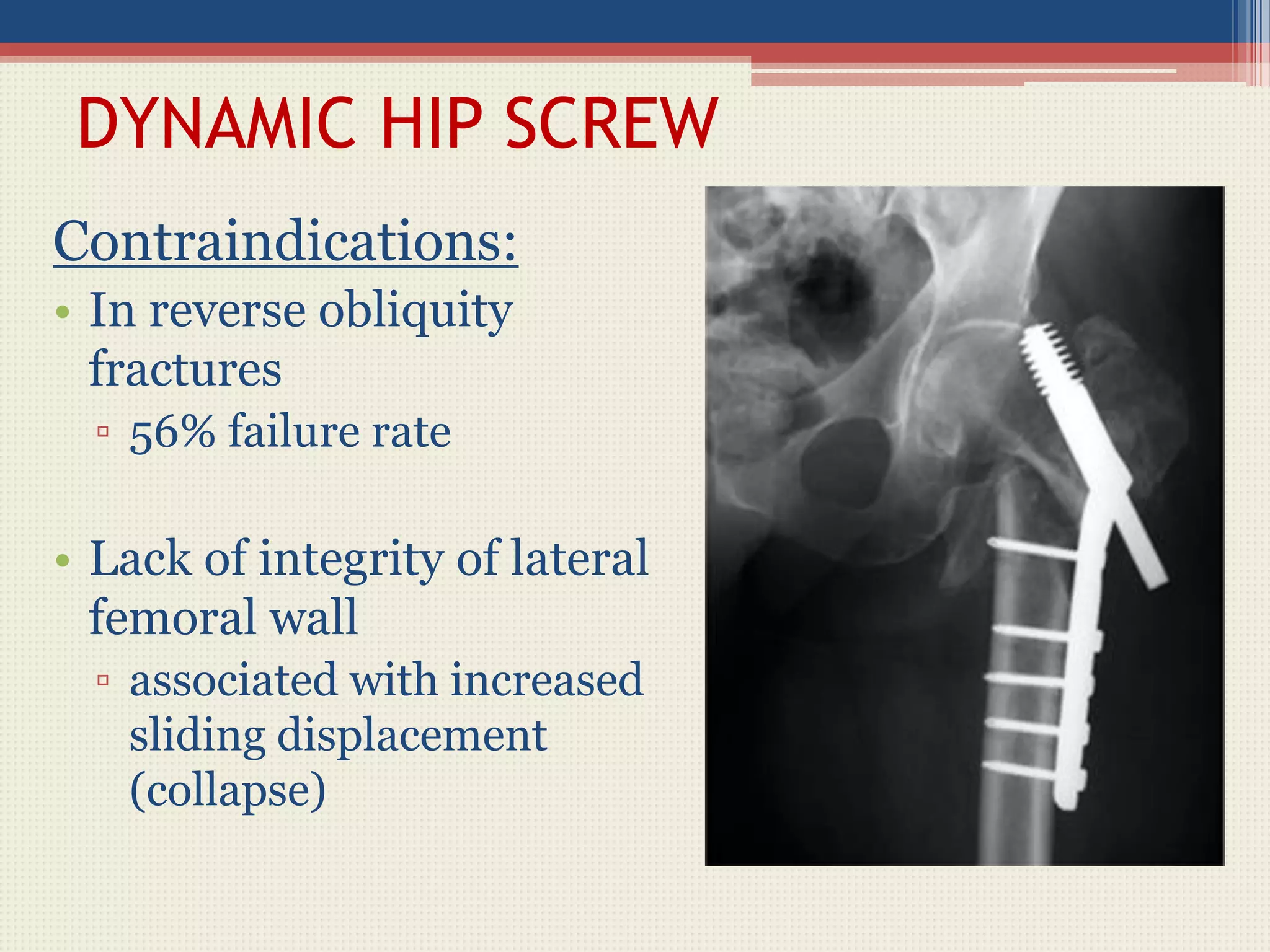 Intertrochanteric fractures and its management with DHS or PFN or ...