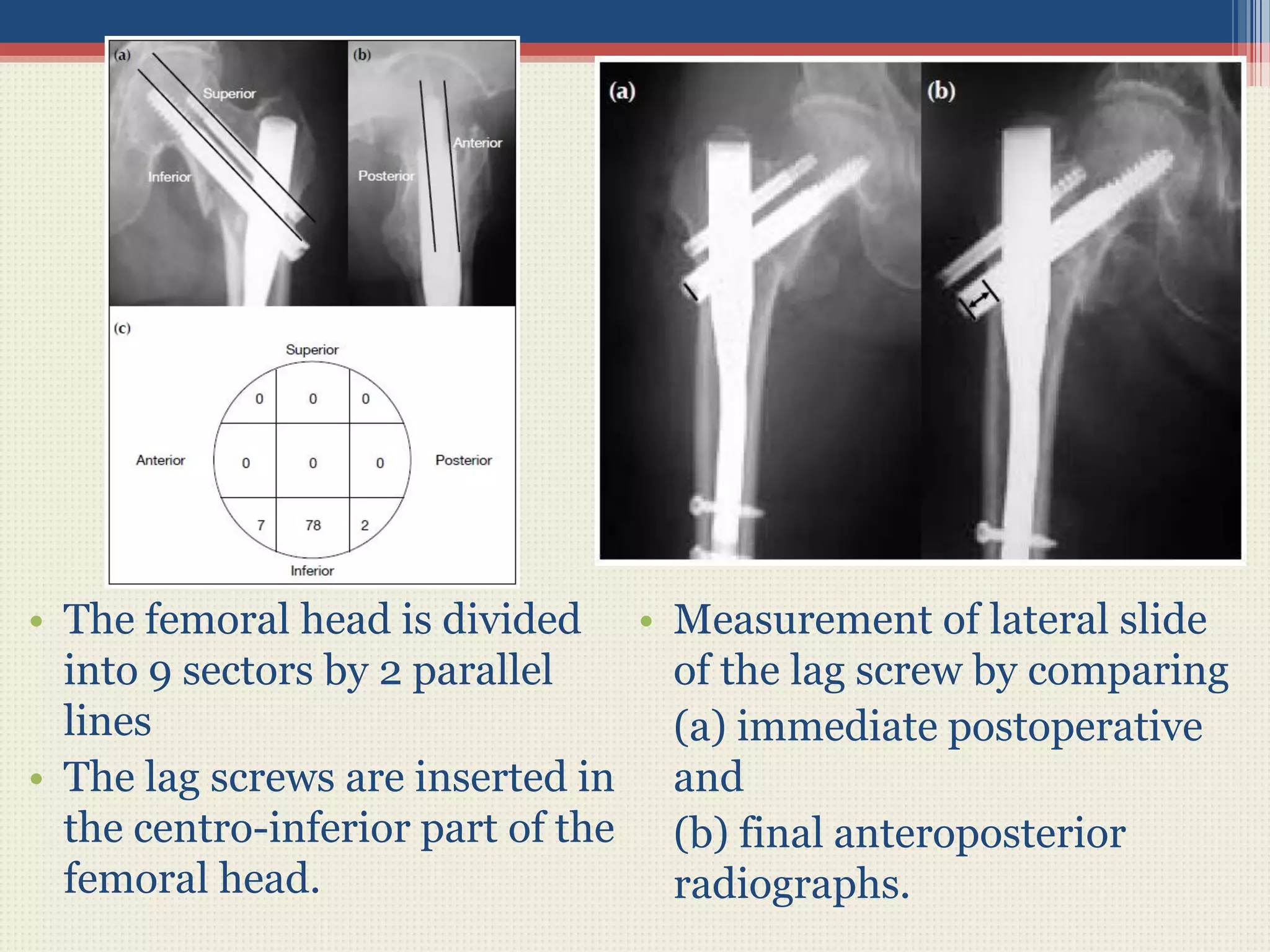 Intertrochanteric fractures and its management with DHS or PFN or ...