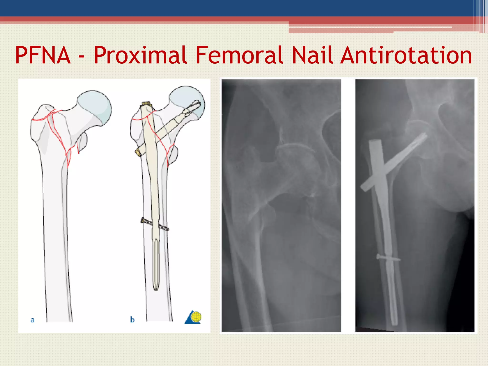 Intertrochanteric fractures and its management with DHS or PFN or Arthroplasty - Dr Kota Aditya ...