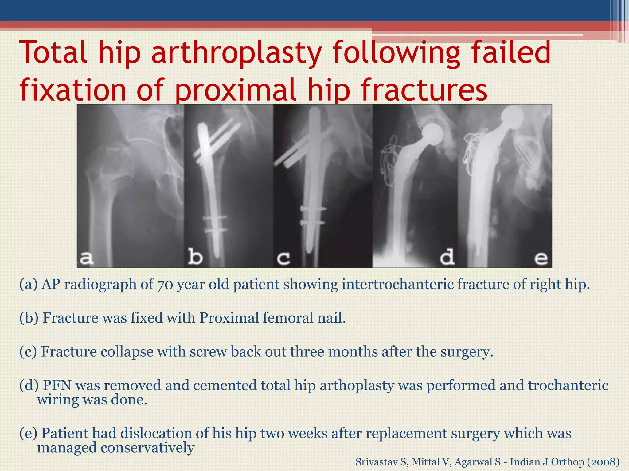 Intertrochanteric fractures and its management with DHS or PFN or ...