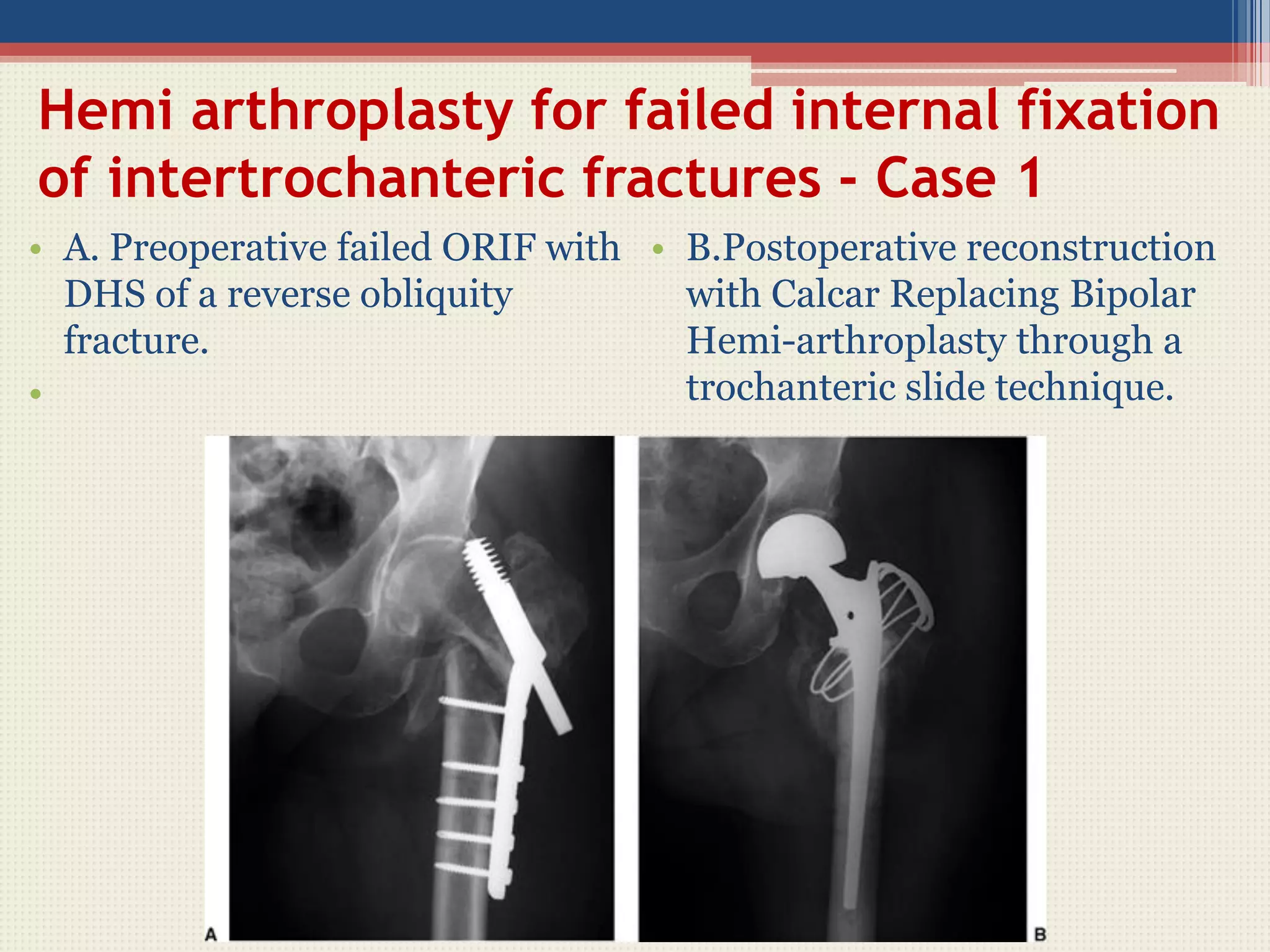 Intertrochanteric fractures and its management with DHS or PFN or Arthroplasty - Dr Kota Aditya ...