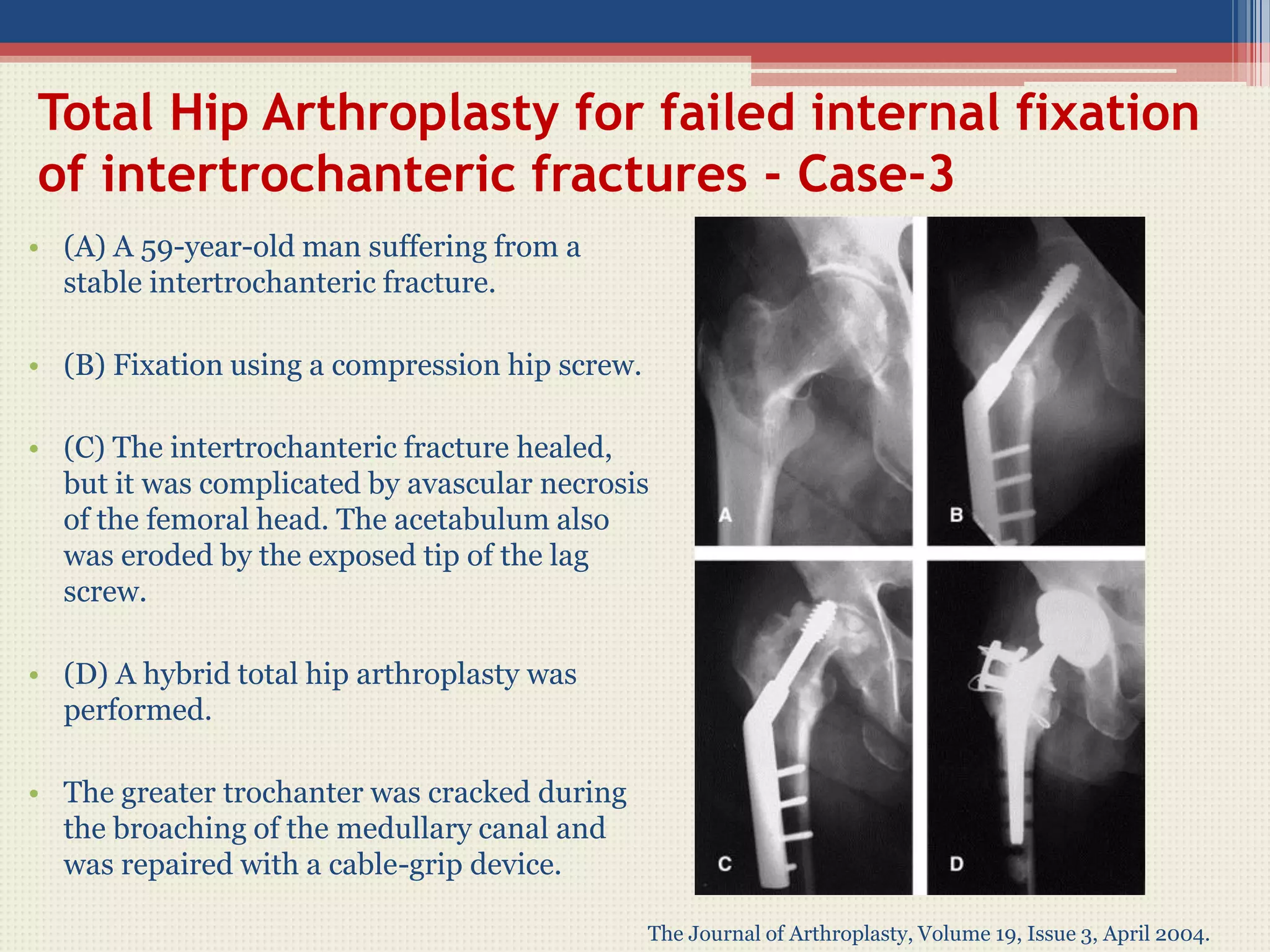Intertrochanteric fractures and its management with DHS or PFN or ...