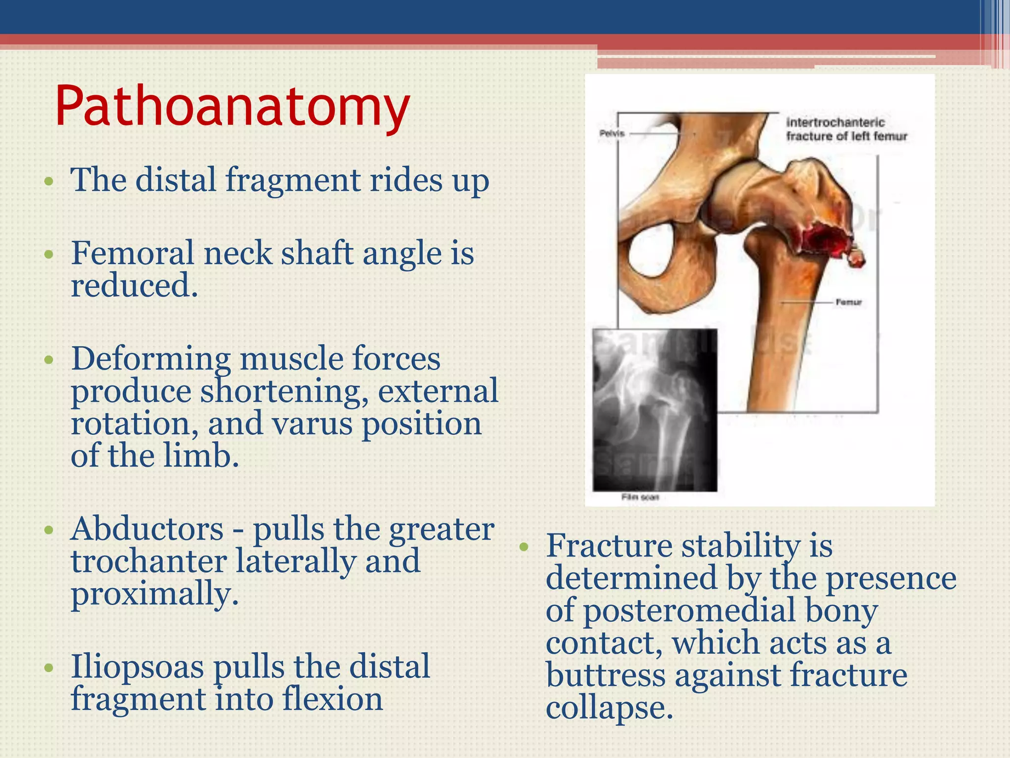 Intertrochanteric fractures and its management with DHS or PFN or ...