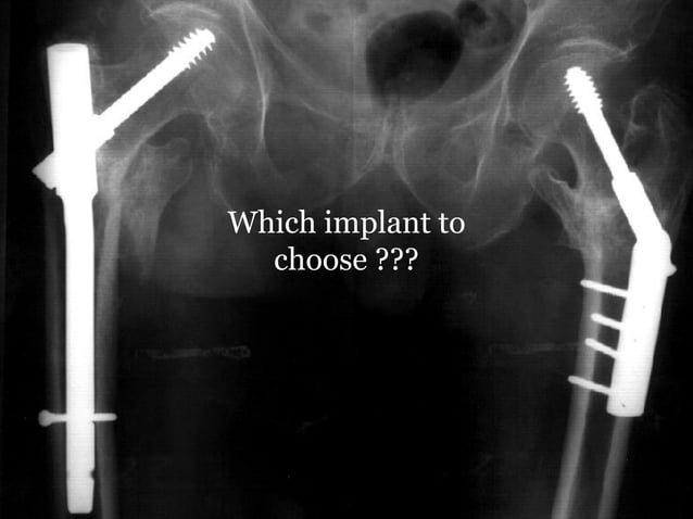 Intertrochanteric fractures and its management with DHS or PFN or ...