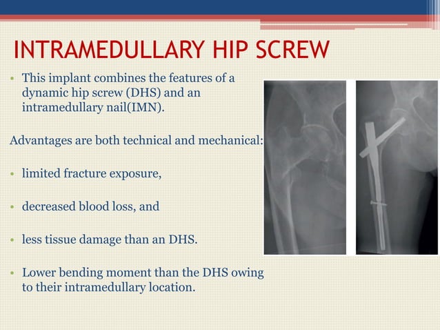 Intertrochanteric fractures and its management with DHS or PFN or ...