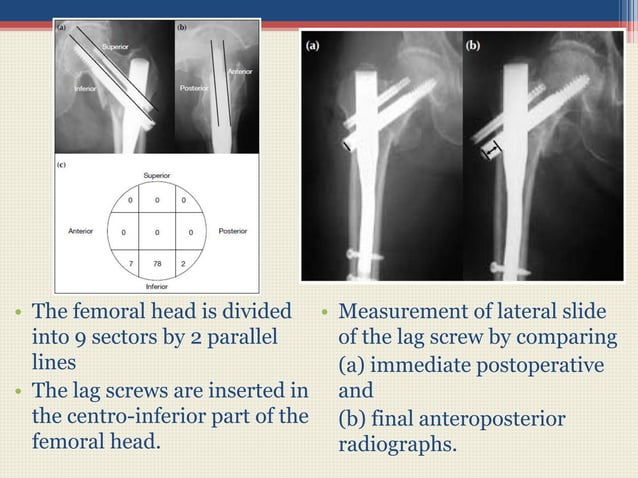 Intertrochanteric fractures and its management with DHS or PFN or Arthroplasty - Dr Kota Aditya ...