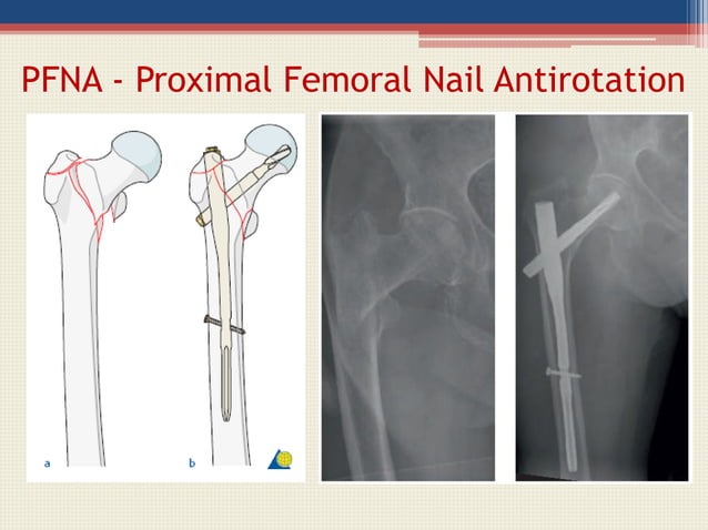 Intertrochanteric fractures and its management with DHS or PFN or ...