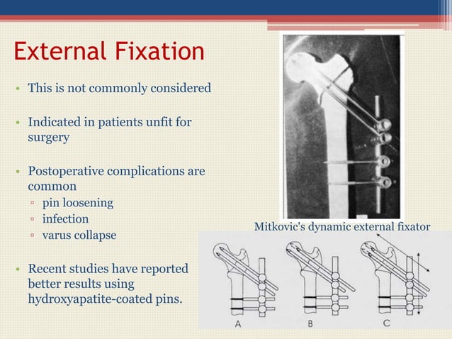 Intertrochanteric fractures and its management with DHS or PFN or ...