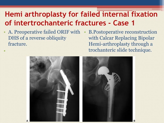 Intertrochanteric fractures and its management with DHS or PFN or ...