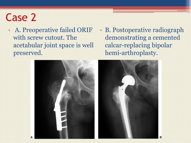 Intertrochanteric fractures and its management with DHS or PFN or ...