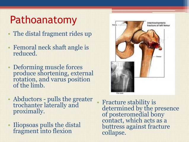 Intertrochanteric fractures and its management with DHS or PFN or ...