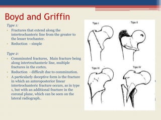 Intertrochanteric Fracture Dhs