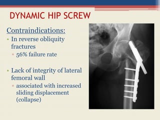 Intertrochanteric Fracture Dhs