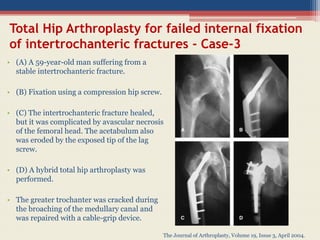 Intertrochanteric Fracture Dhs