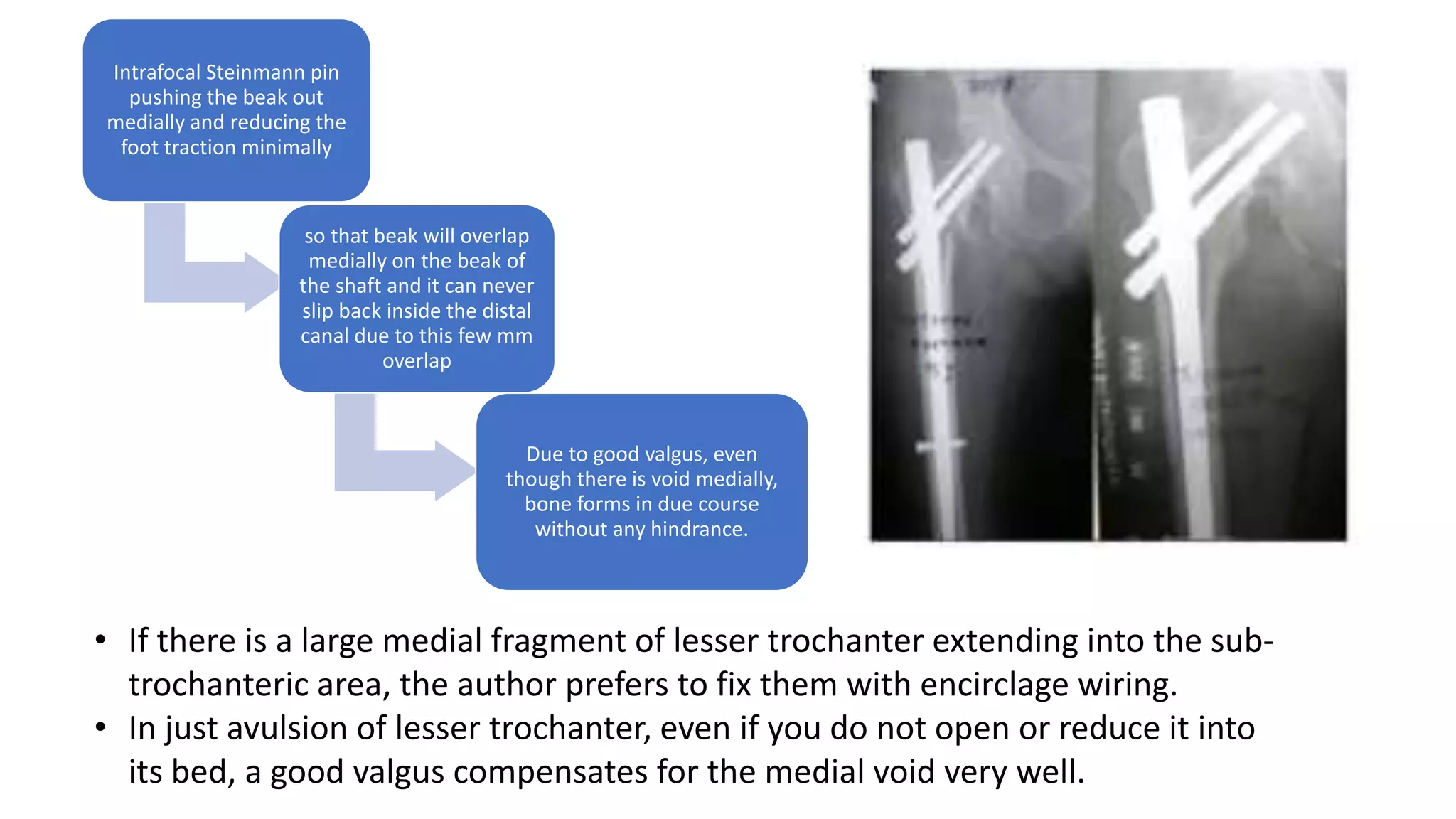 Intertrochanteric Fractures: Ten Commandments for How to Get Good ...