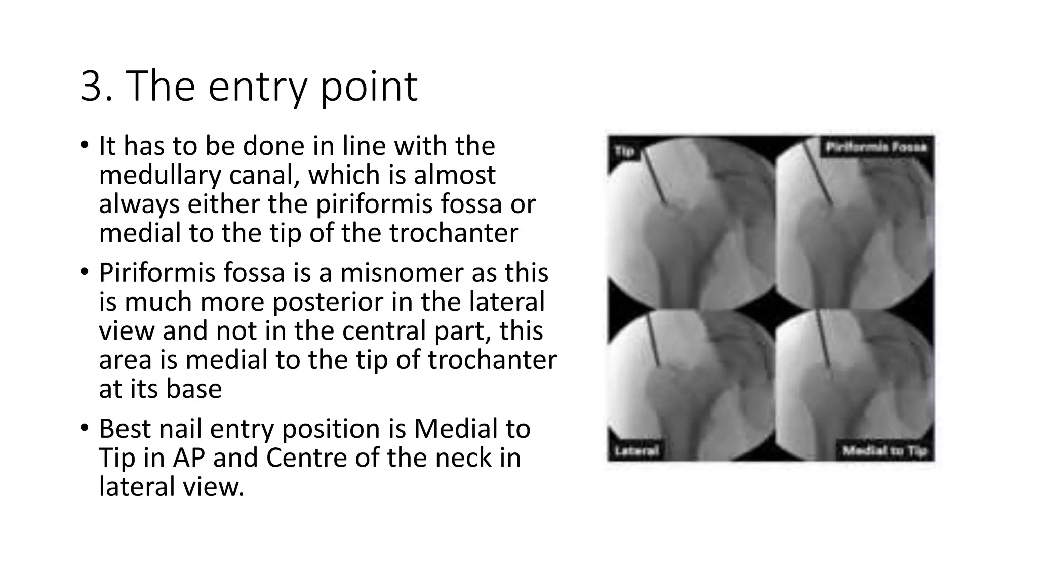 Intertrochanteric Fractures: Ten Commandments for How to Get Good ...