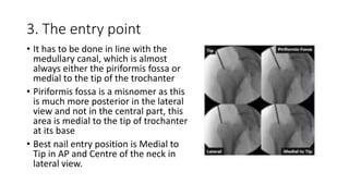 Intertrochanteric Fractures: Ten Commandments for How to Get Good ...
