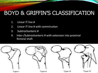 intertrochantericfractures | PPTX