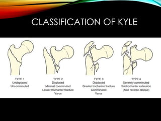 Evans Hip Fracture Classification