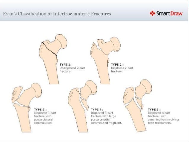 InterTrochanteric Fractures
