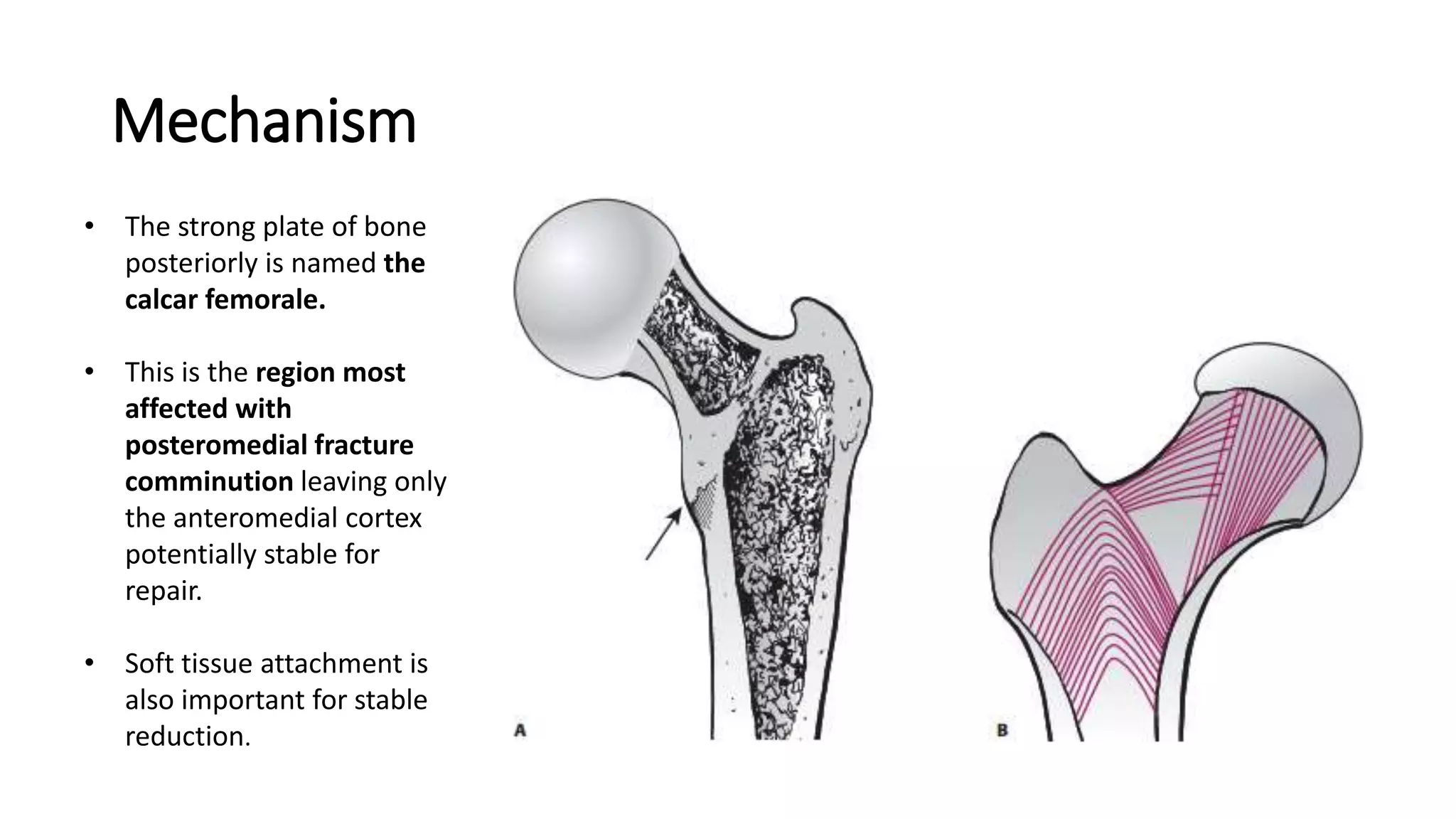 Intertrochanteric Fractures of Femur | PPTX