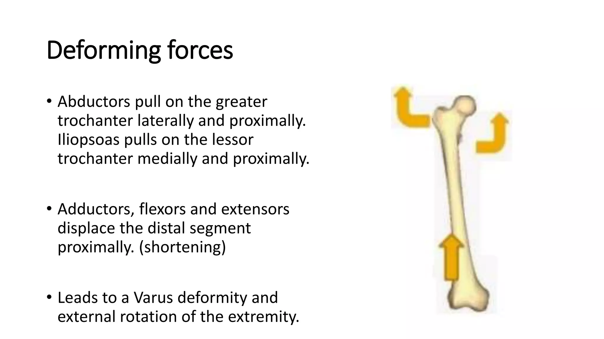 Intertrochanteric Fractures of Femur | PPTX