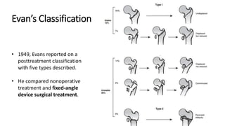 Evans Hip Fracture Classification