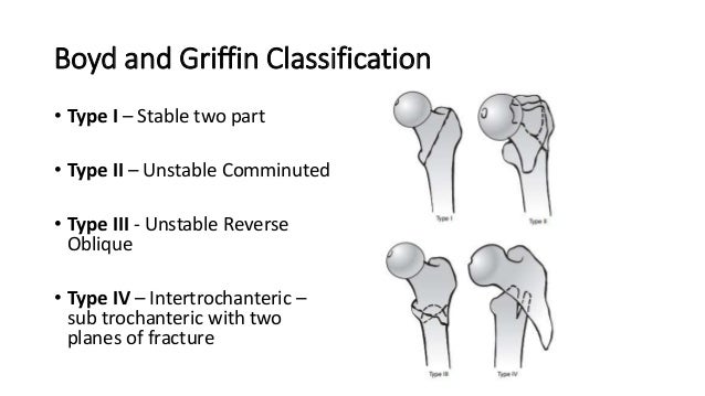 Intertrochanteric Fractures of Femur