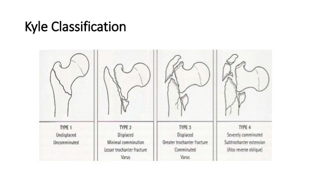Intertrochanteric Fractures of Femur