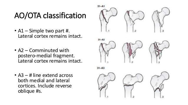 Intertrochanteric Fractures of Femur
