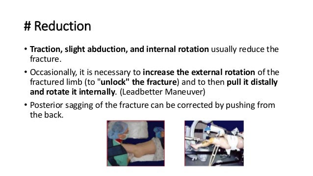 Intertrochanteric Fractures of Femur