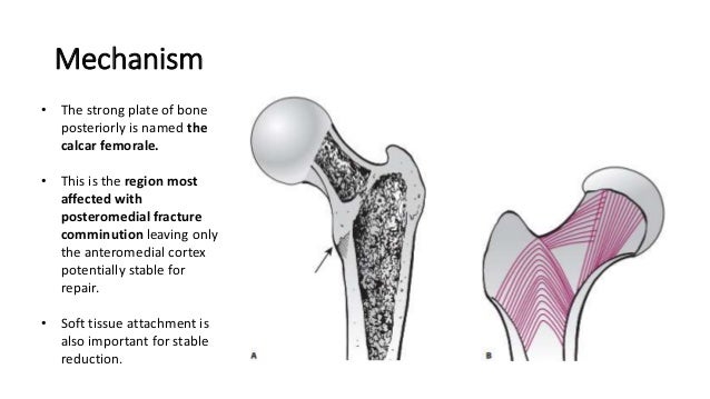 Intertrochanteric Fractures of Femur