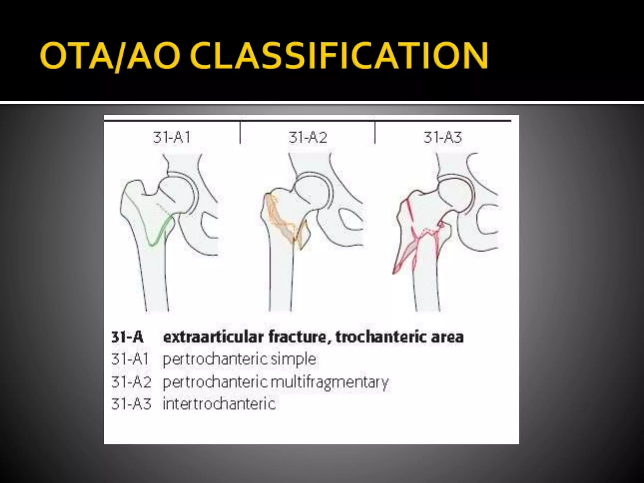 Intertrochanteric fractures of the femur | PPTX
