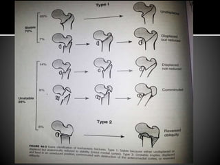 Evans Hip Fracture Classification
